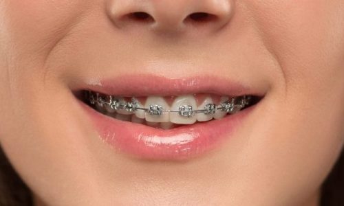 Brackets Convencionales - Clínica Clínica Ortodent, Tenerife